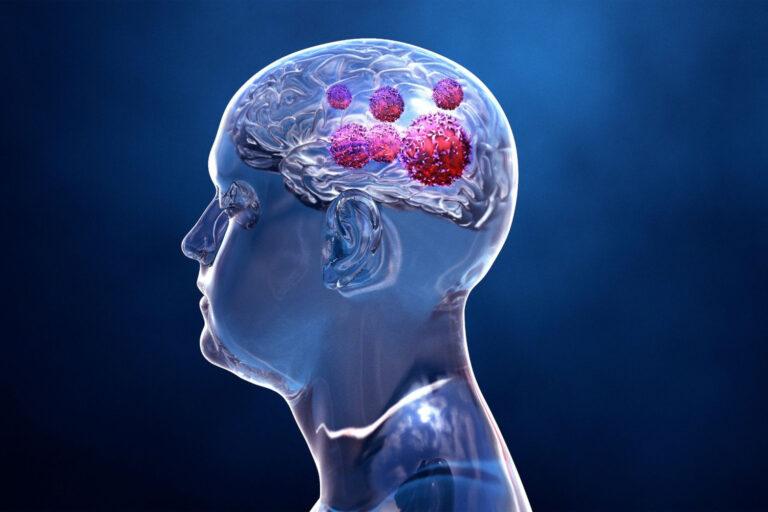 The 4 Types of Brain Injuries You Should Know About